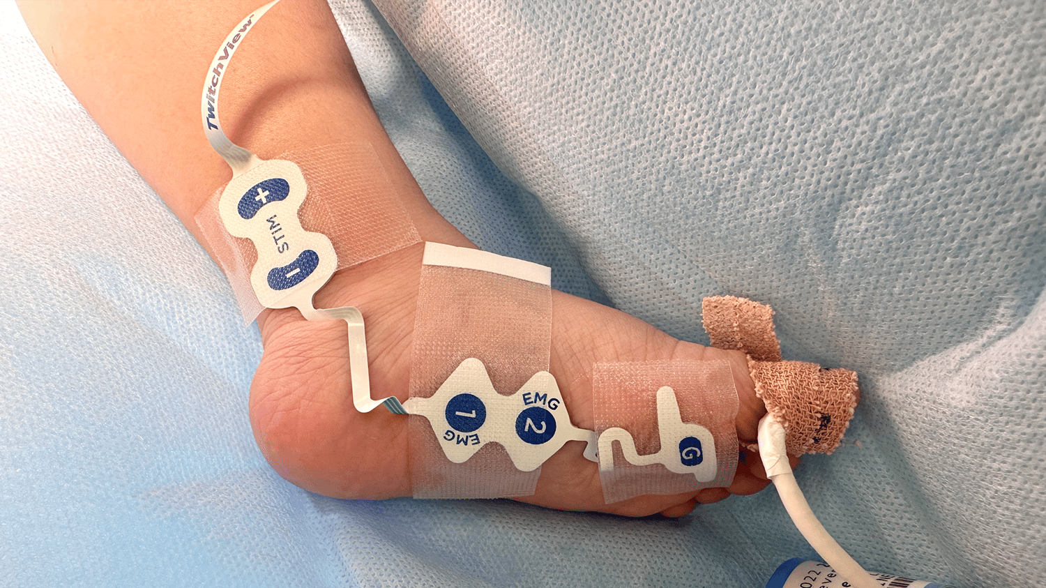 TwitchView2 | Quantitative Neuromuscular Blockade Monitor