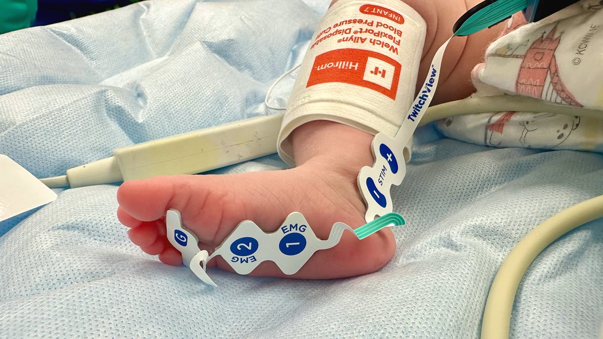 TwitchView2 | Quantitative Neuromuscular Blockade Monitor