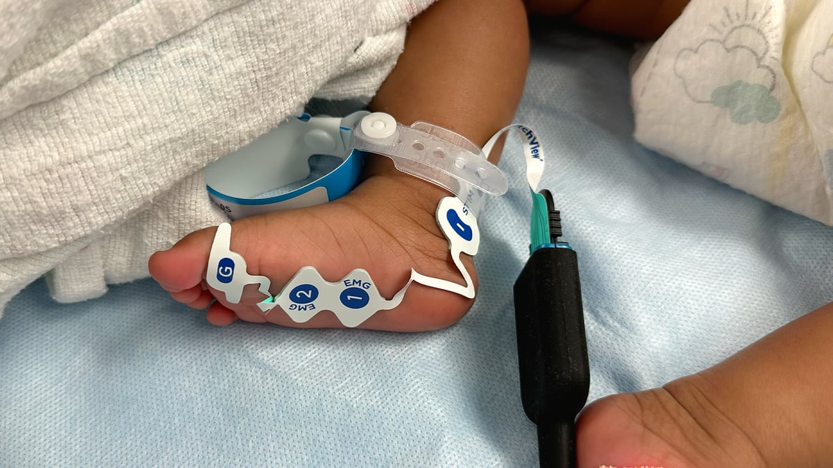 TwitchView2 | Quantitative Neuromuscular Blockade Monitor