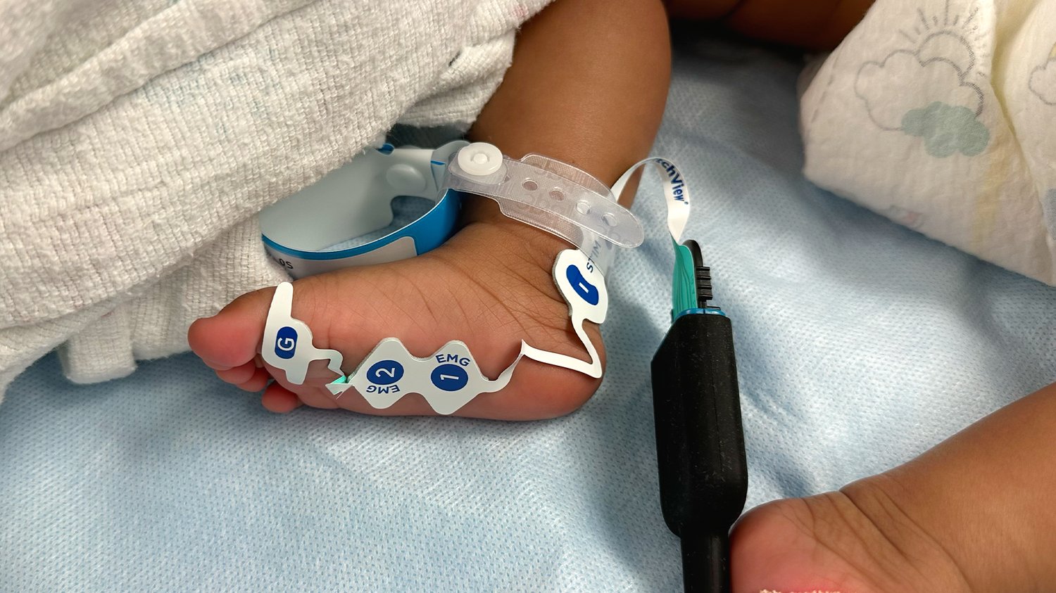 TwitchView2 | Quantitative Neuromuscular Blockade Monitor