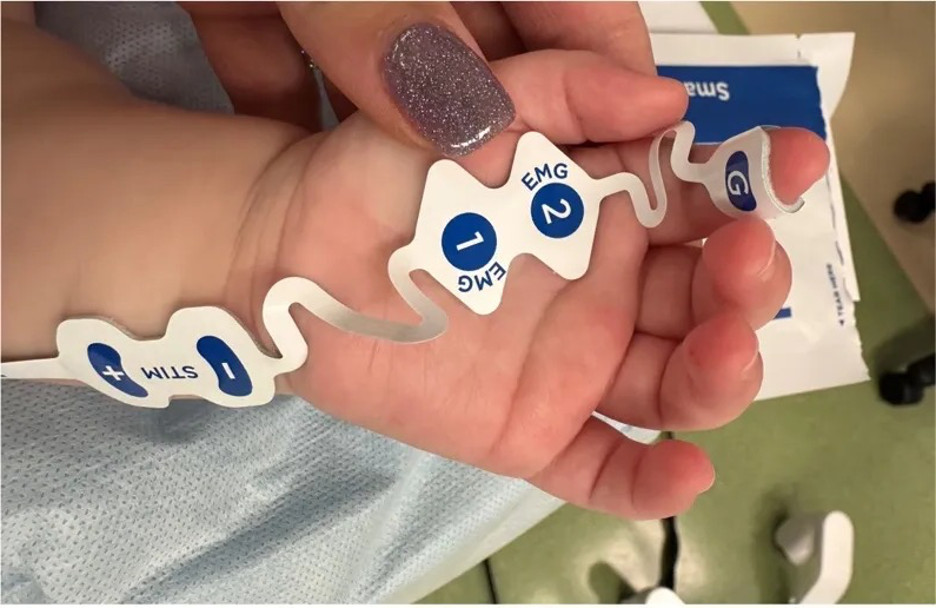 Do Infants Require Less Supramaximal Ulnar Nerve Current? The Answer ...