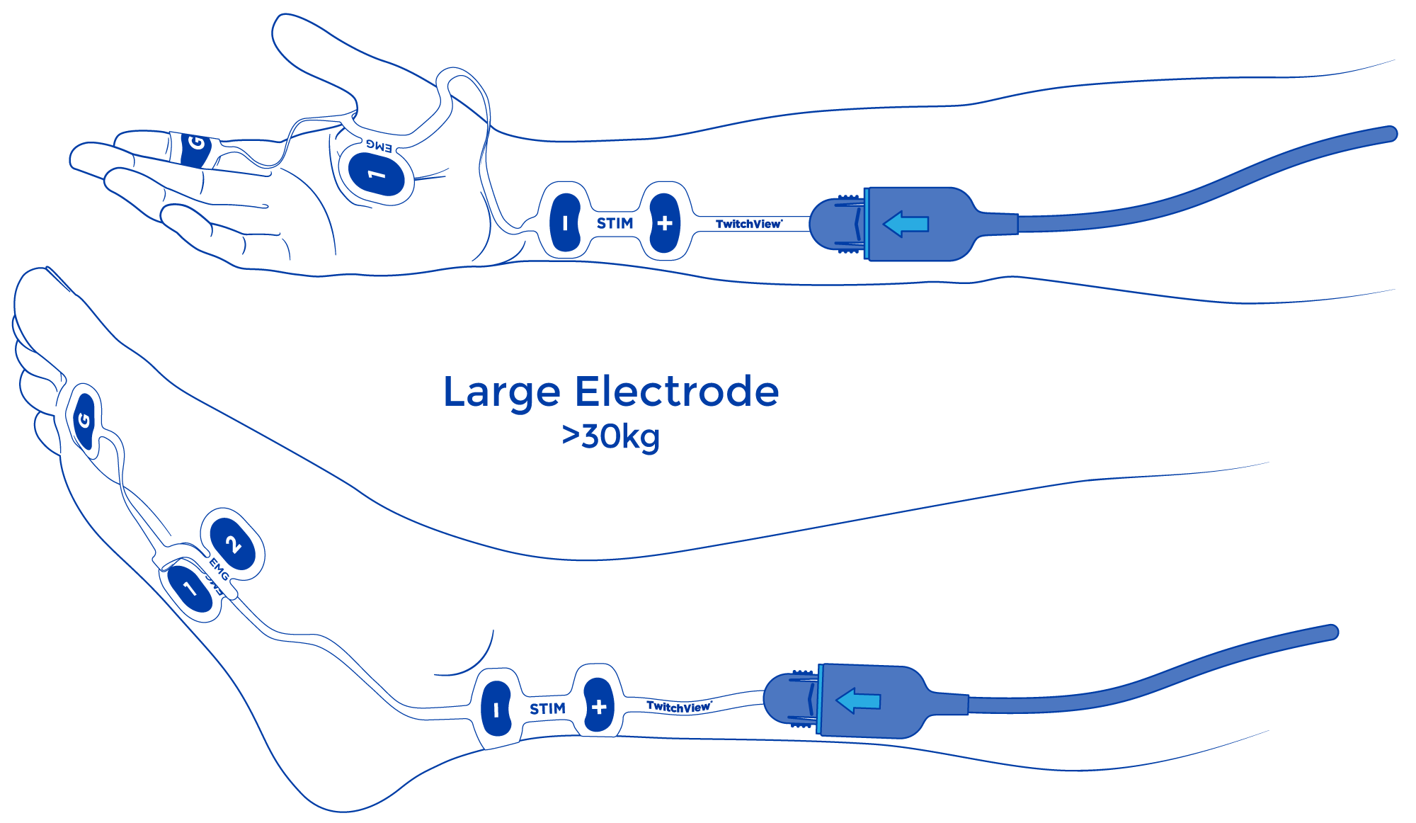TwitchView2 | Quantitative Neuromuscular Blockade Monitor