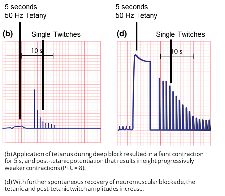 How to Use Post-Tetanic Count (PTC) to Manage Neuromuscular Blockade