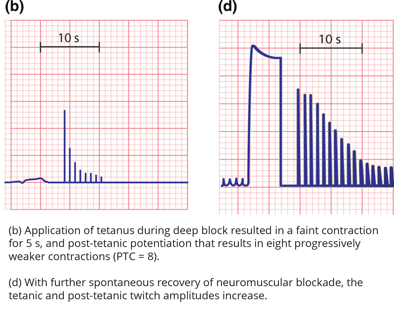 How to Use Post-Tetanic Count (PTC) in the Clinical Setting