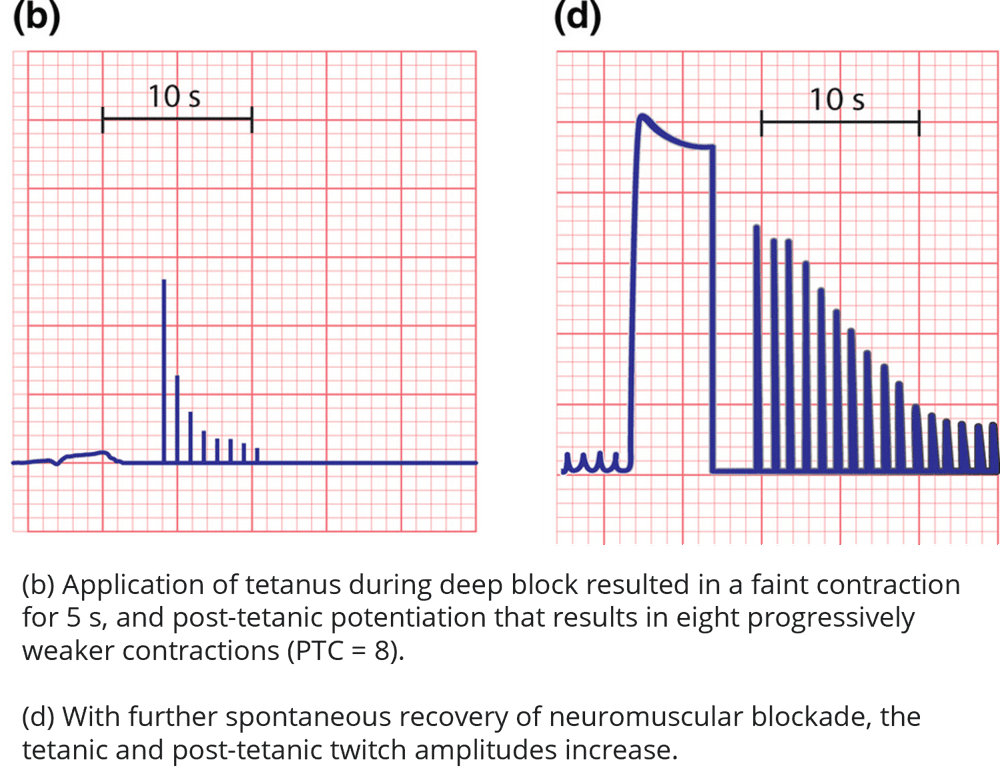 How to Use Post-Tetanic Count (PTC) in the Clinical Setting
