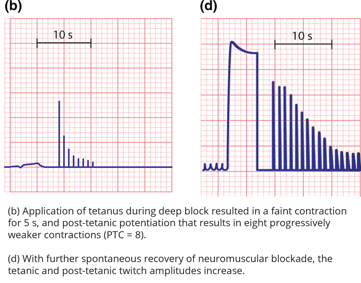 How to Use Post-Tetanic Count (PTC) in the Clinical Setting
