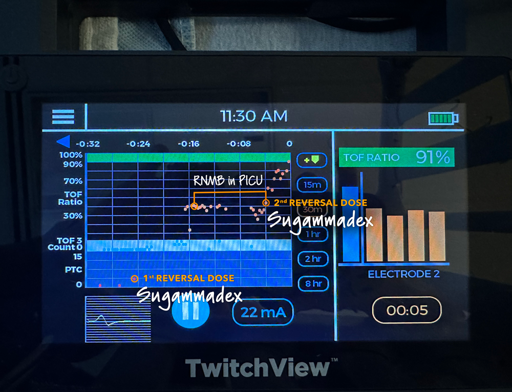 Can Residual Neuromuscular Blockade (RNMB) Cause Post-Operative ...