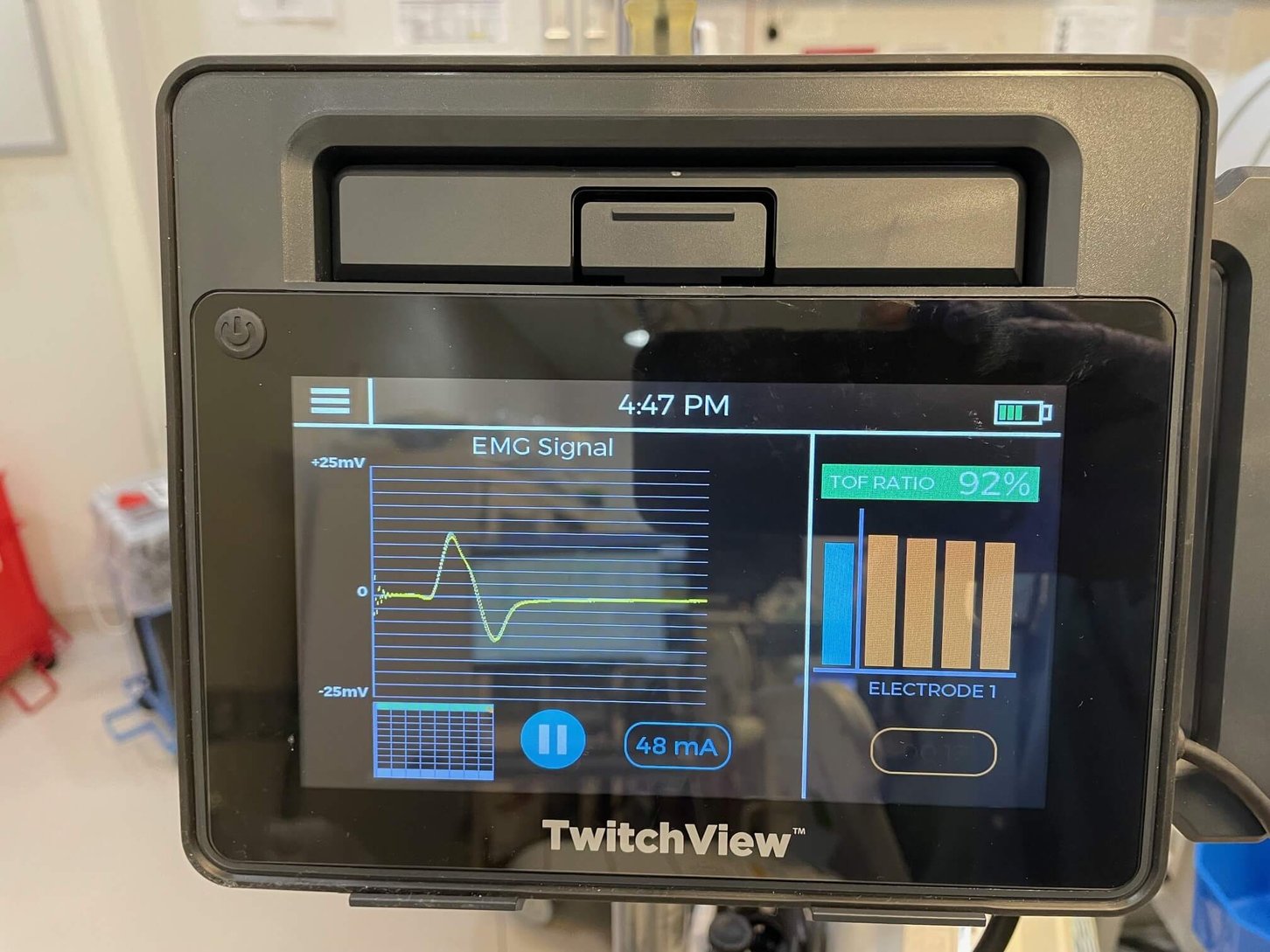 How to Monitor Succinylcholine-Induced Neuromuscular Blockade