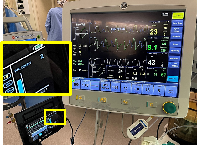 How to Use Post-Tetanic Count (PTC) to Manage Neuromuscular Blockade